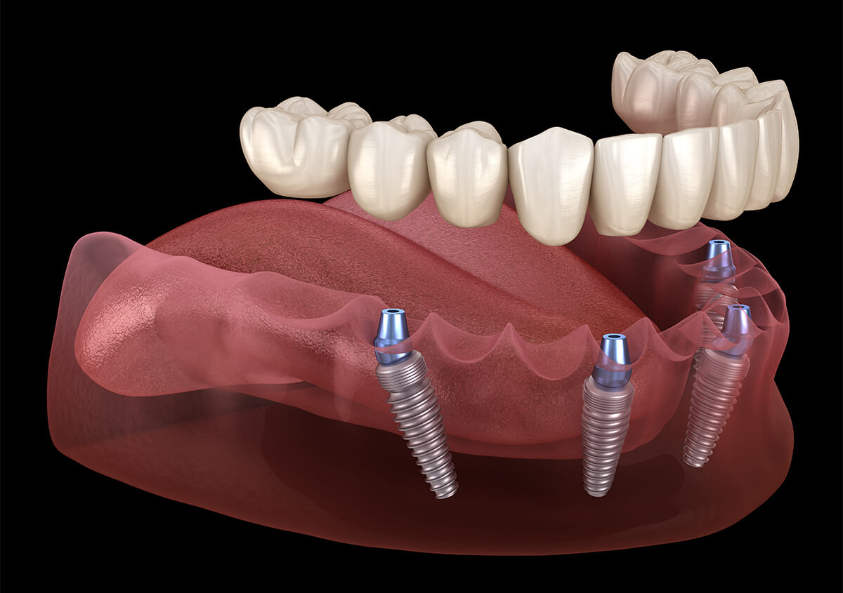 Lower Implant Retained Dentures Calgary AB - How Its Work