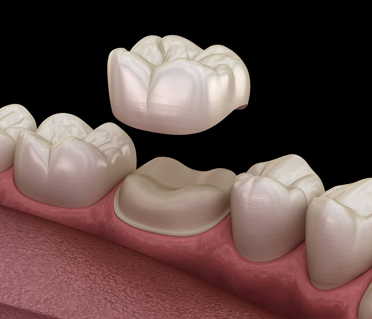 Same-Day Dental Restorations Calgary AB - CEREC Technology